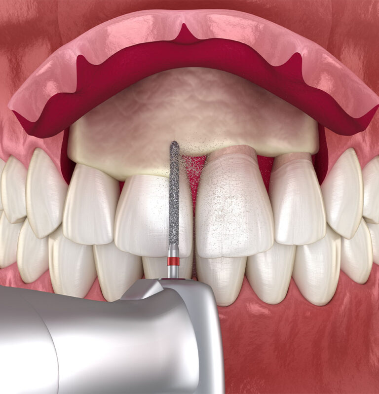 Gingivectomy | Frenectomy | Monroe & Livingston County, NY