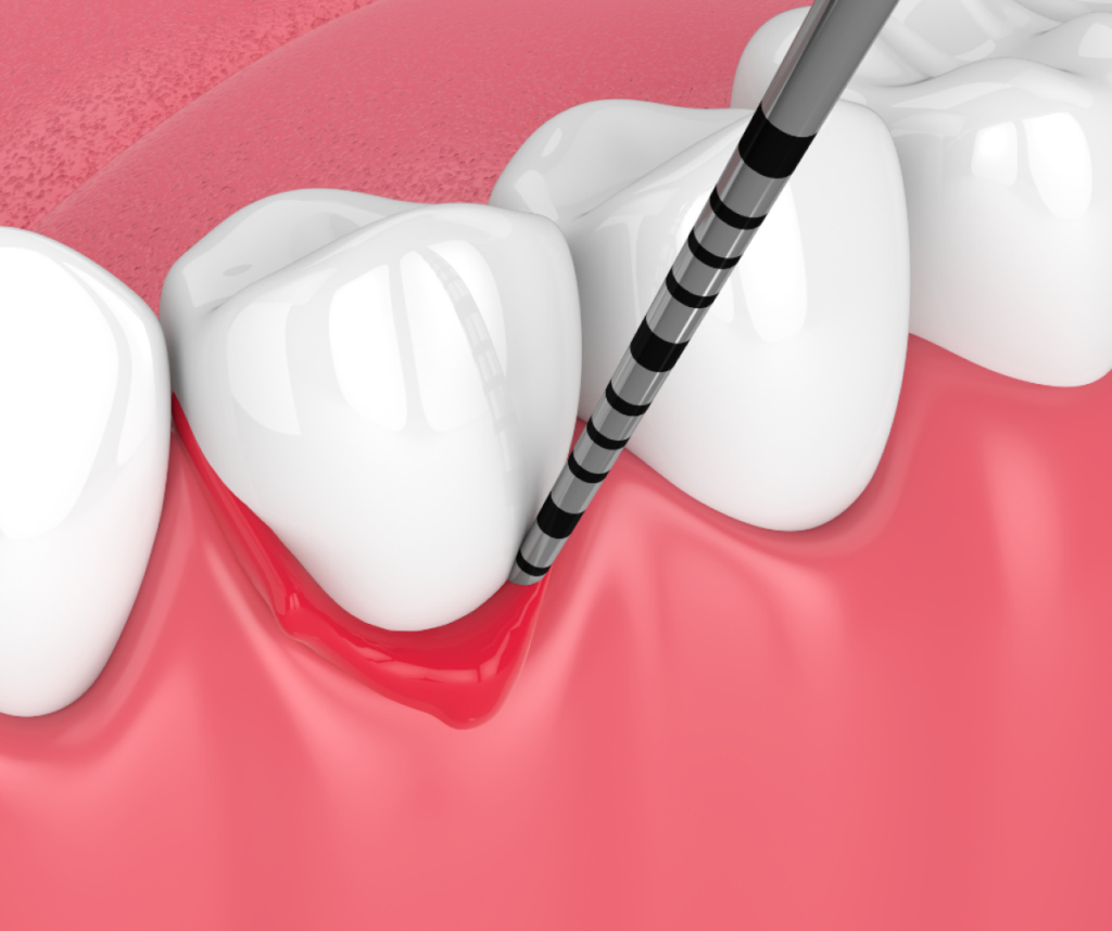 Periodontal Pockets: What They Are and How to Treat | Progressive Implantology & Periodontics